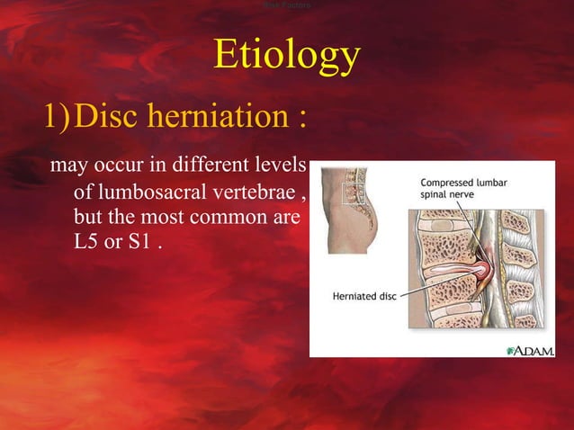 Sciatica | PPT | Death, Injury, or Military Conflict | Sensitive Topics