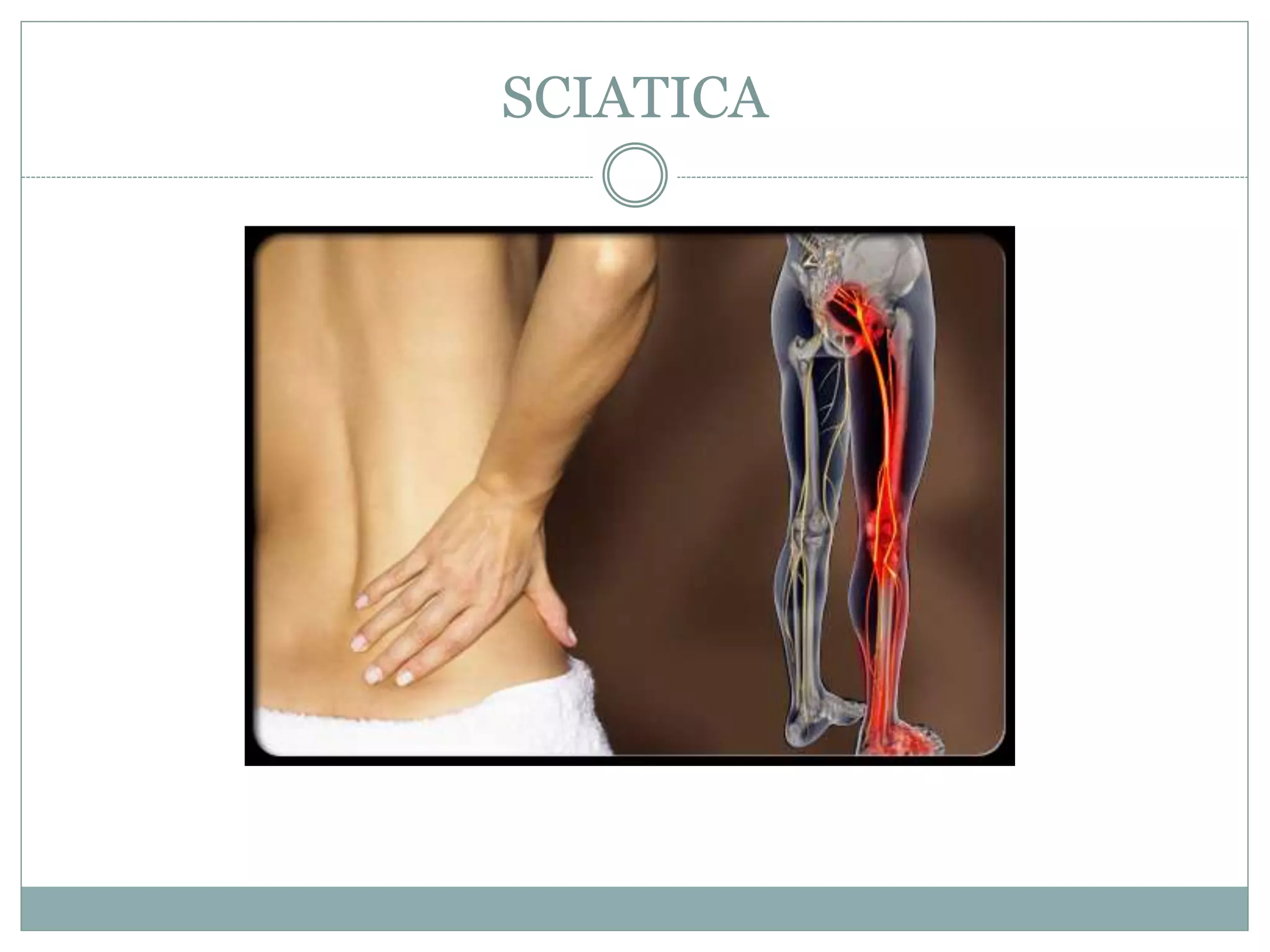 Sciatica | PPTX