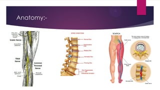 Sciatica | PDF