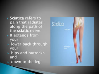 Sciatica- Dr. Diksha Gondkar, MPT (Neuro) | PPT