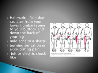 Sciatica- Dr. Diksha Gondkar, MPT (Neuro) | PPT