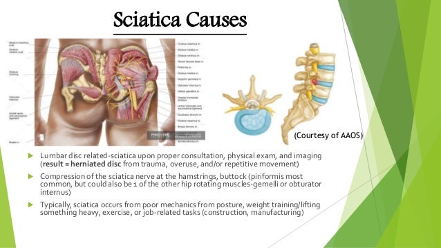 Sciatica - A Huge Pain in the Butt | PPTX