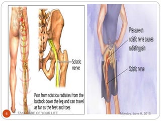 Sciatica | PPTX