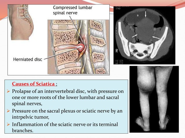Sciatic Nerve.pdf Physiotherapy treatment | PPT
