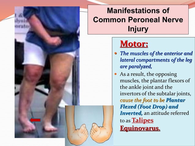 Sciatic Nerve.pdf Physiotherapy treatment | PPT