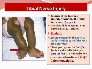 Sciatic Nerve.pdf Physiotherapy treatment | PPT