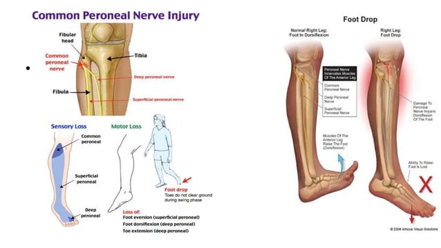 ANATOMY OF SCIATIC NERVE AND FOOT DROP | PPTX