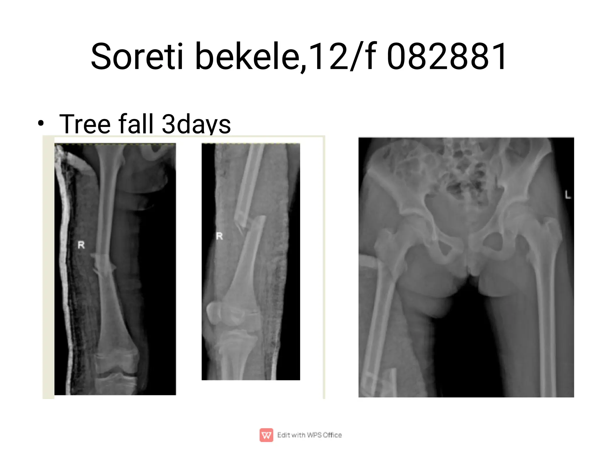 Sciatic nerve injury in femur shaft fracture.pdf | Death, Injury, or ...