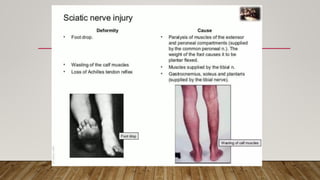 Sciatic Nerve PDF | PDF