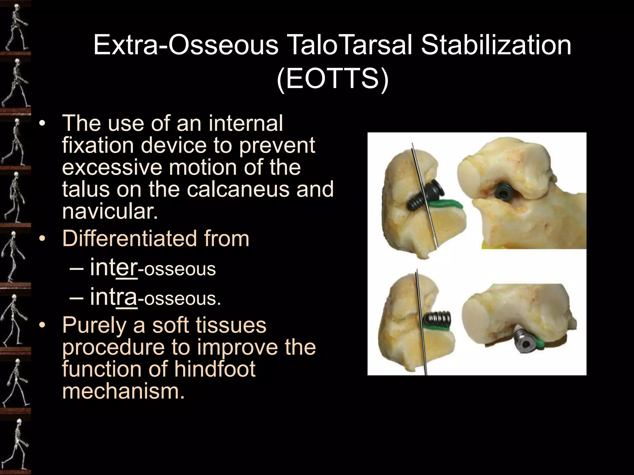 Extra-Osseous TaloTarsal Stabilization - HyProCure: The Scientific ...