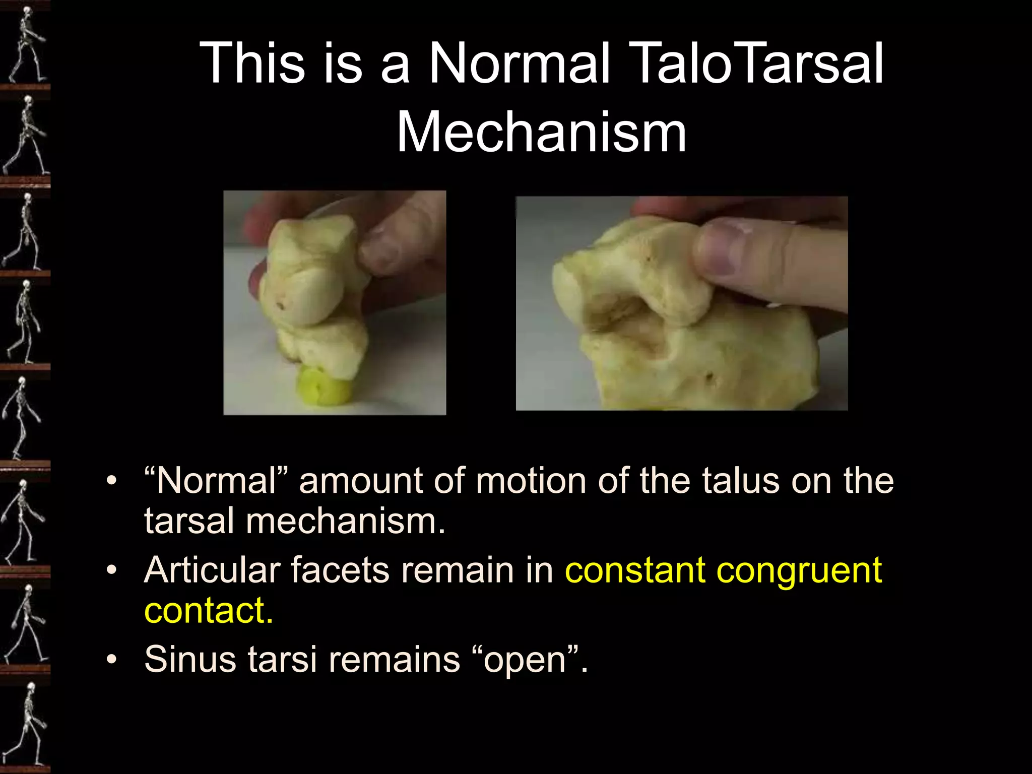 Extra-Osseous TaloTarsal Stabilization - HyProCure: The Scientific ...