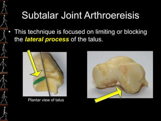 Extra-Osseous TaloTarsal Stabilization - HyProCure: The Scientific ...
