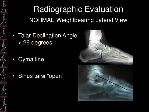 Extra-Osseous TaloTarsal Stabilization - HyProCure: The Scientific Ev…