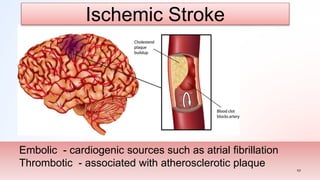 Management of stroke | PPTX