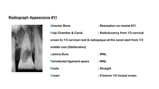 Scientific Award internal root resorptionguided endodontic.pptx