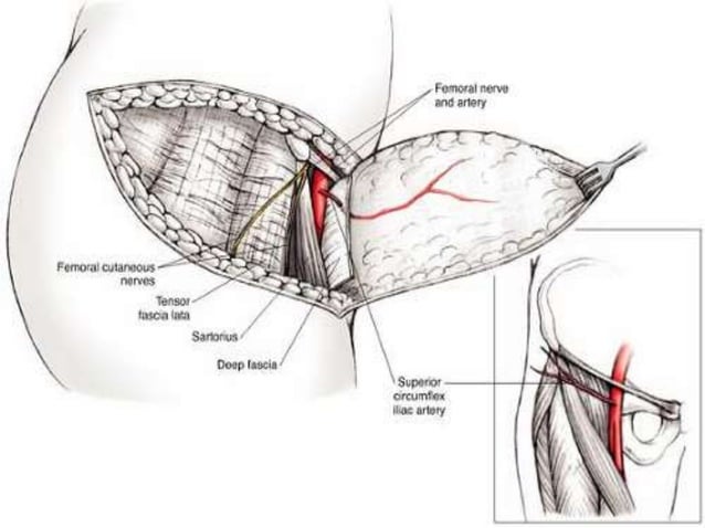 SCIP Flap -Dr Junaid Khurshid | PPTX