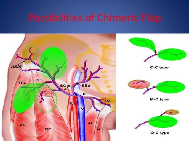 SCIP Flap -Dr Junaid Khurshid