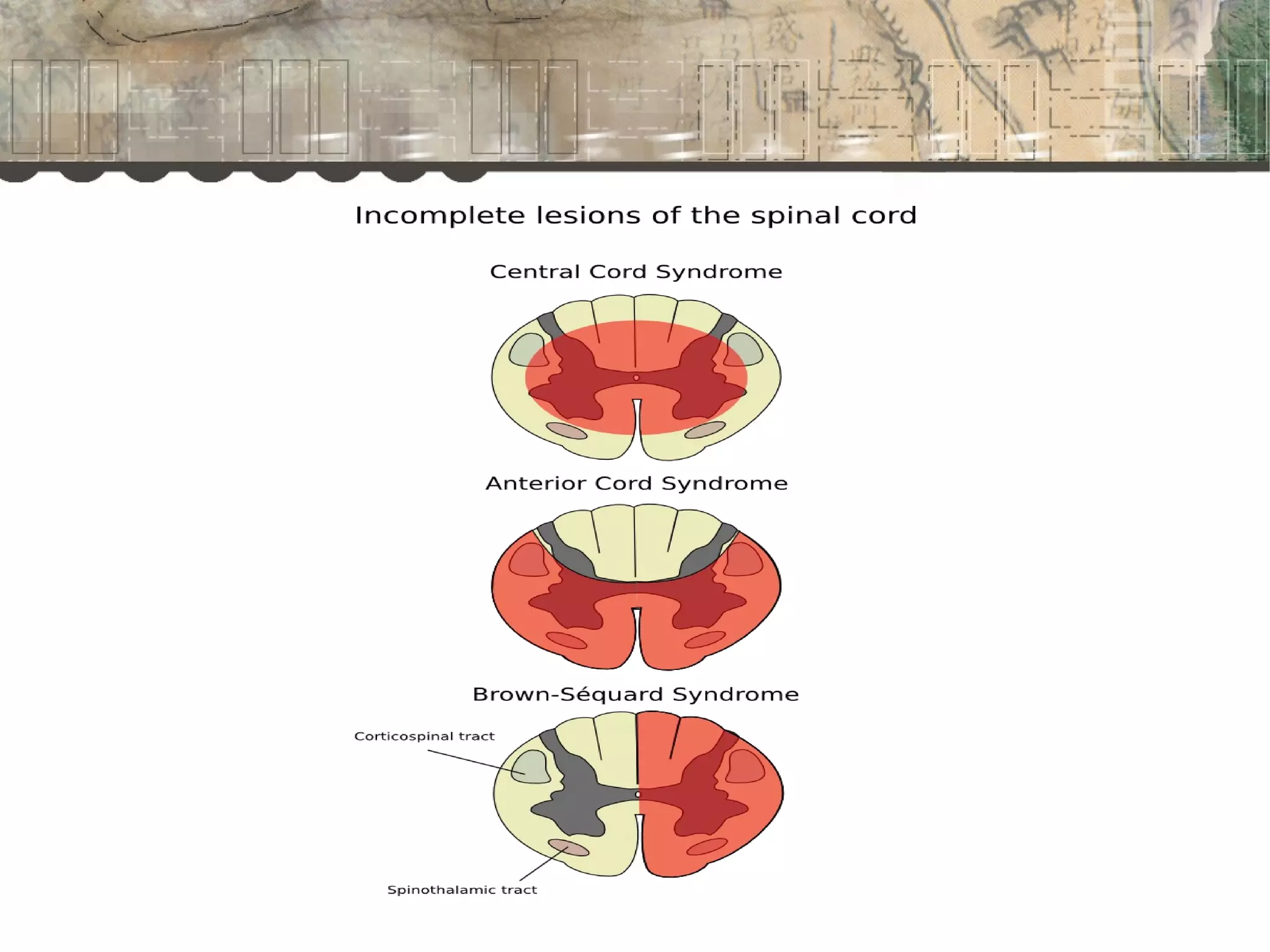 Spinal cord injury | PPT