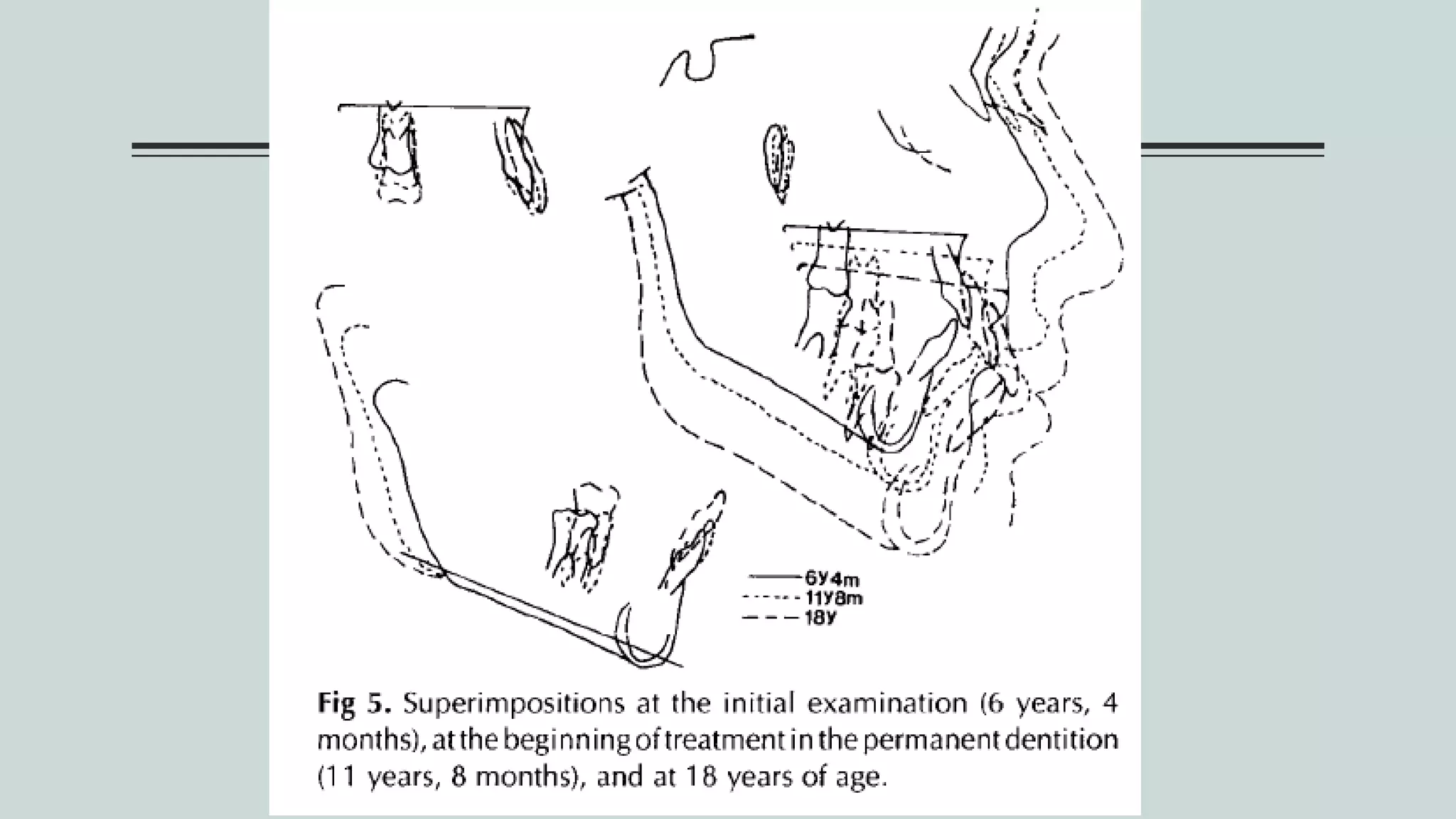 Scissor. telescope. brodie. bite | PPTX