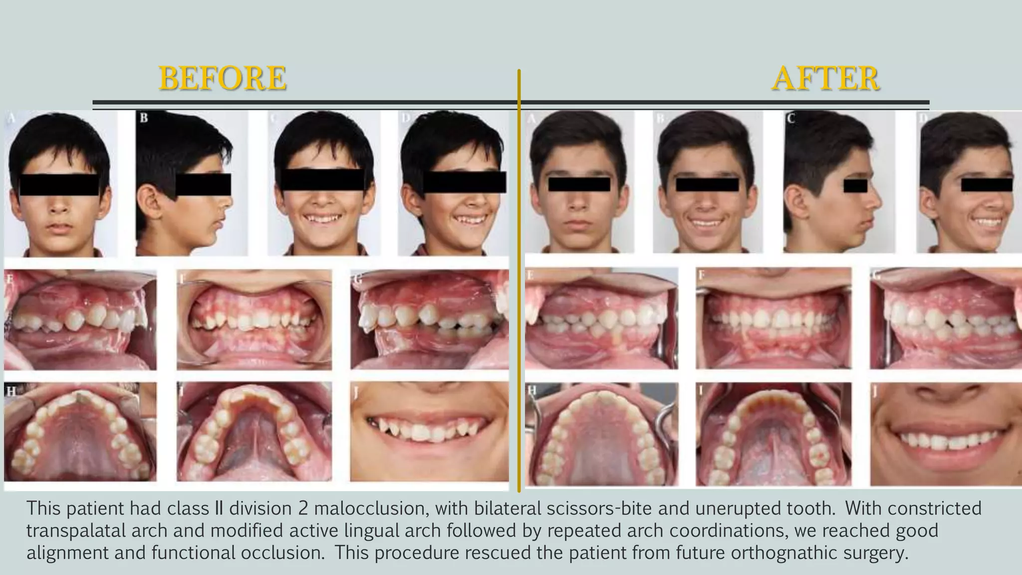 Scissor. telescope. brodie. bite | PPTX