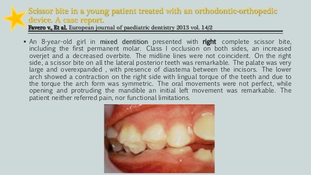 Actually i have many problems, overbite, slanted teeth, recessed chin ...