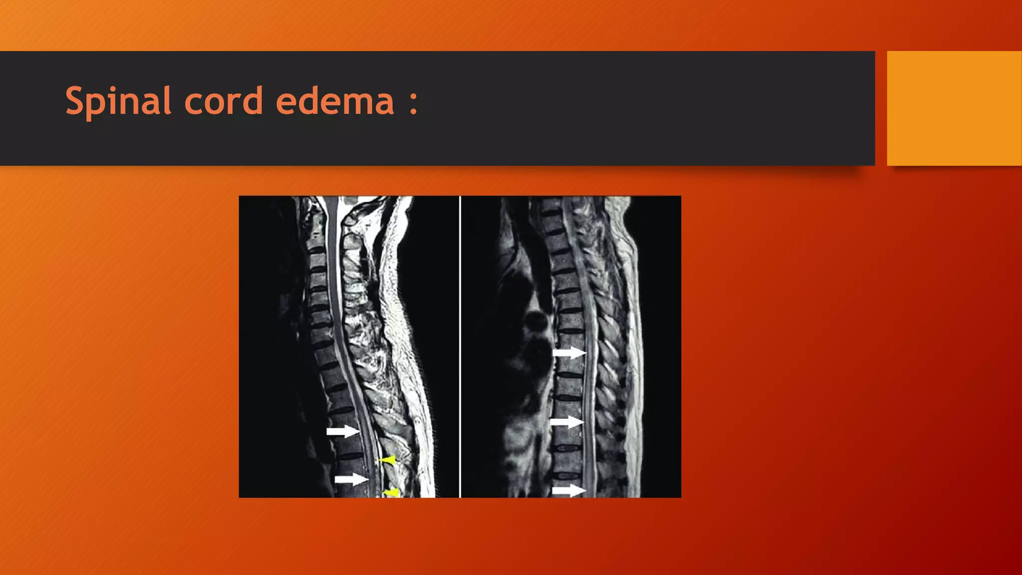 Spinal cord injury without radiographic abnormalities (SCIWORA) | PPT