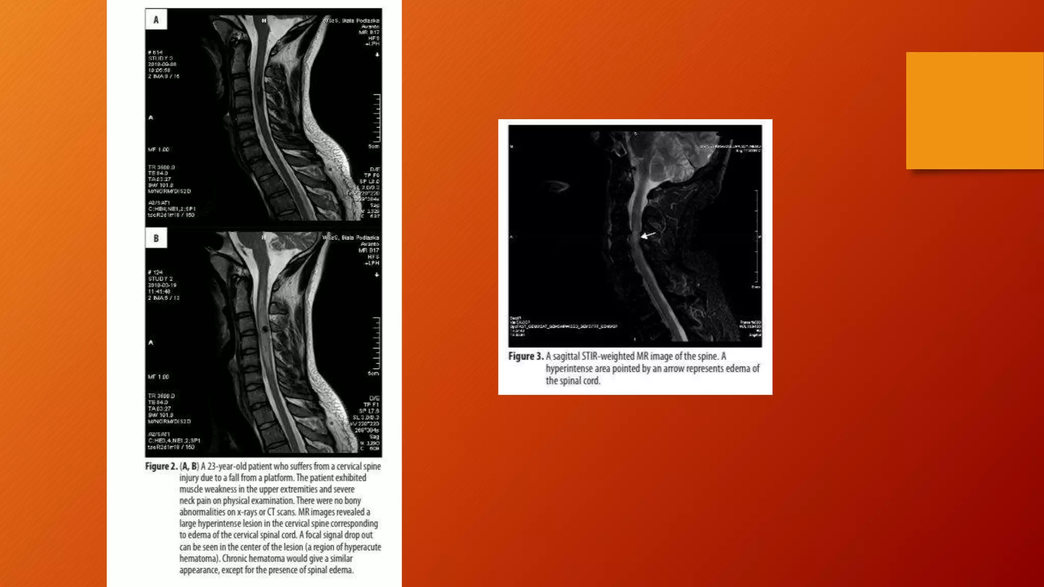 Spinal cord injury without radiographic abnormalities (SCIWORA) | PPT