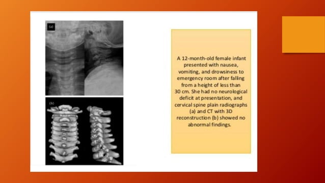 Spinal cord injury without radiographic abnormalities (SCIWORA) | PPT
