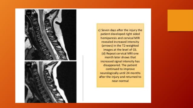 Spinal cord injury without radiographic abnormalities (SCIWORA) | PPT