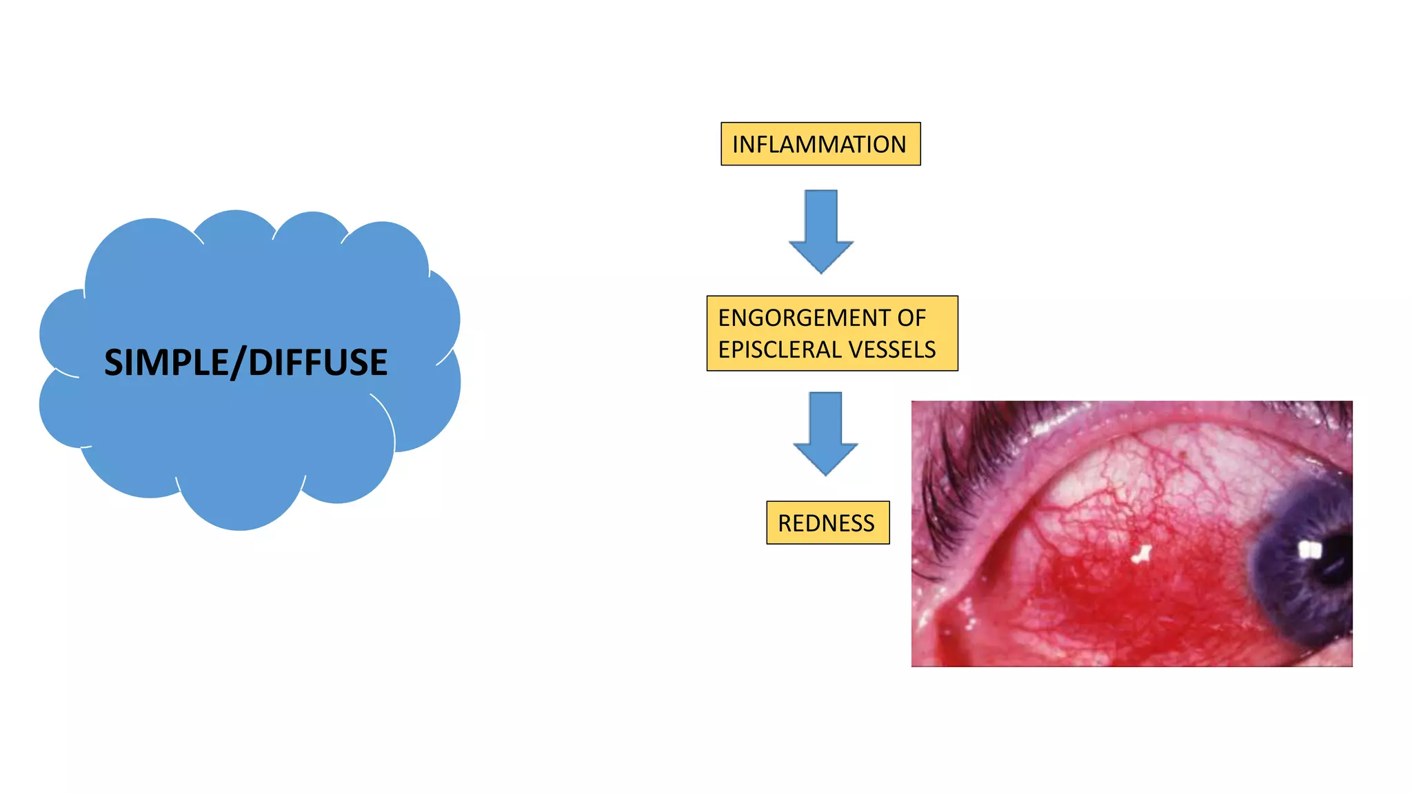 Episcleritis and scleritis | PPTX