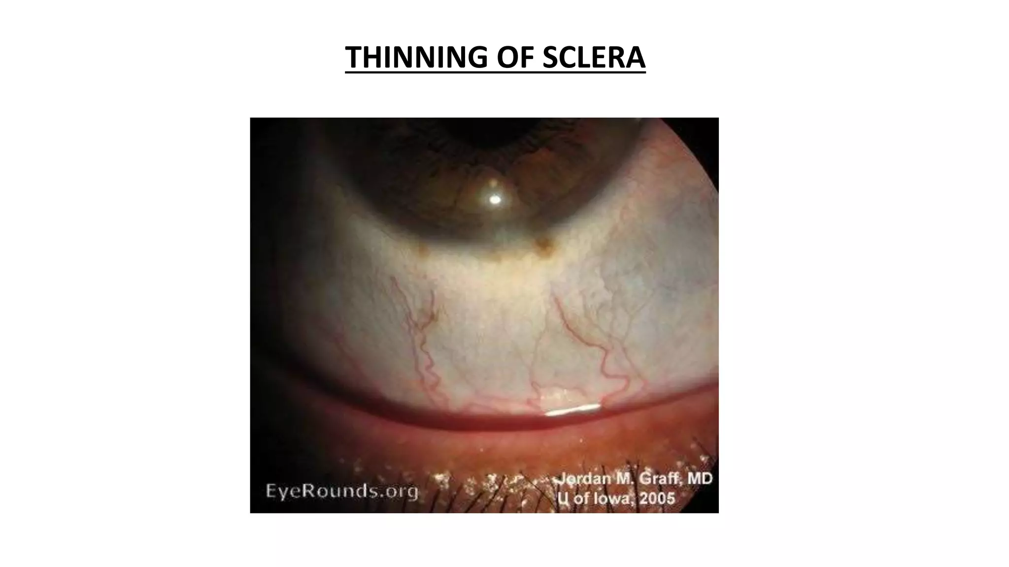 Episcleritis and scleritis | PPTX