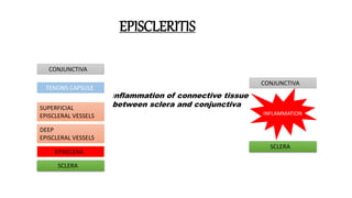 Episcleritis and scleritis | PPTX | Eye and Vision Conditions ...