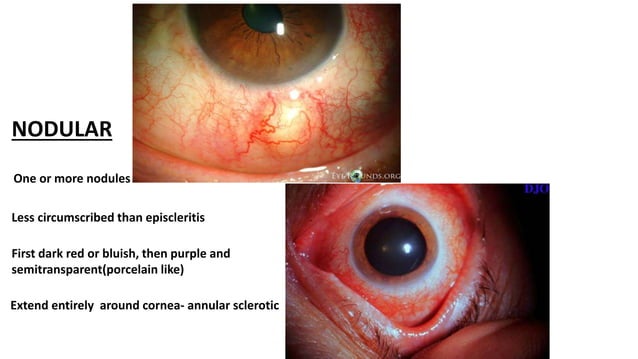 Episcleritis and scleritis | PPTX | Eye and Vision Conditions ...