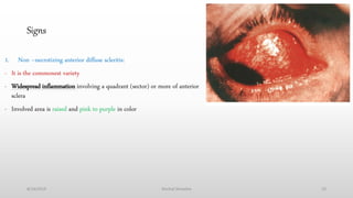 Sclera | PPTX