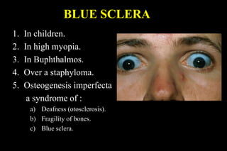 Sclera | PPT