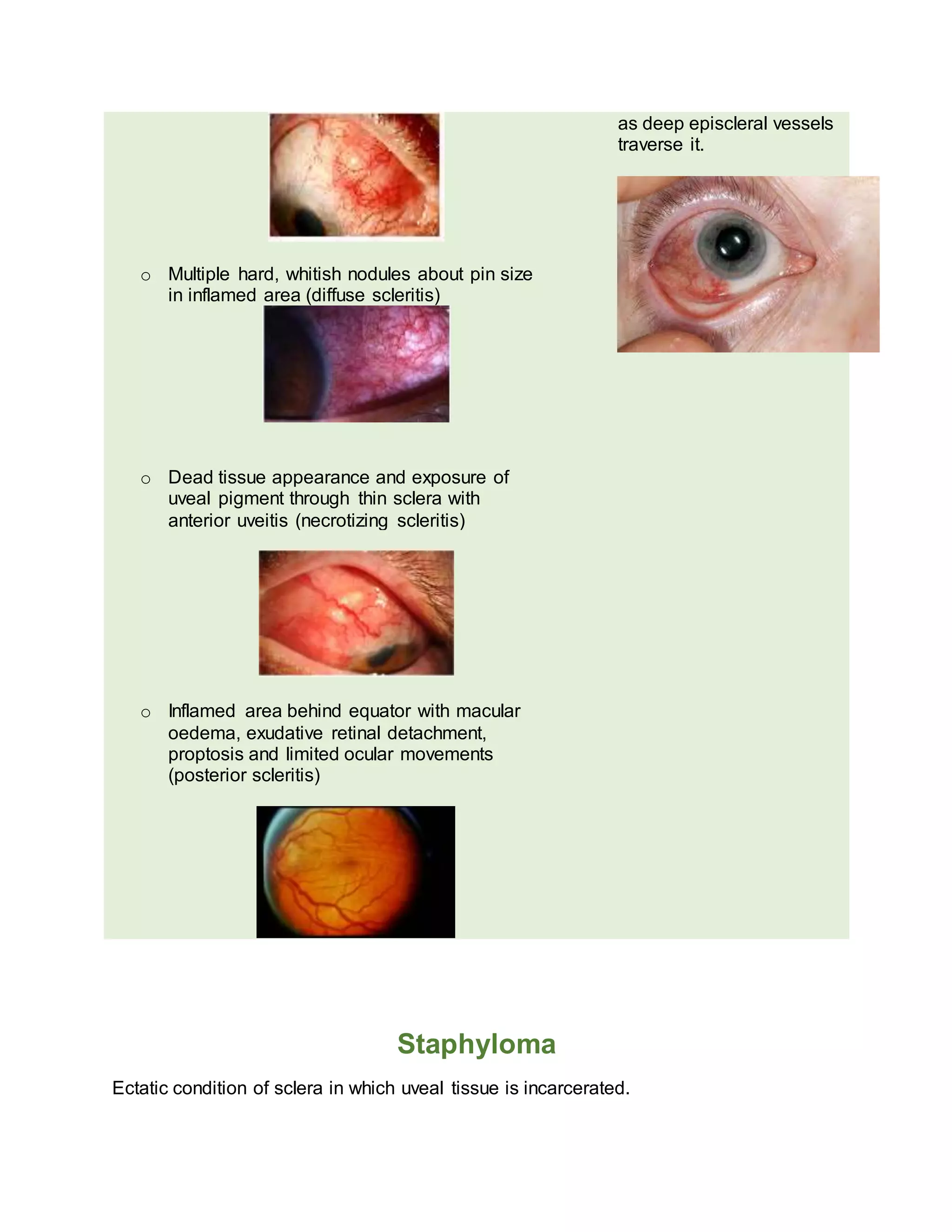 Sclera (scleritis and episcleritis, staphyloma) | DOCX
