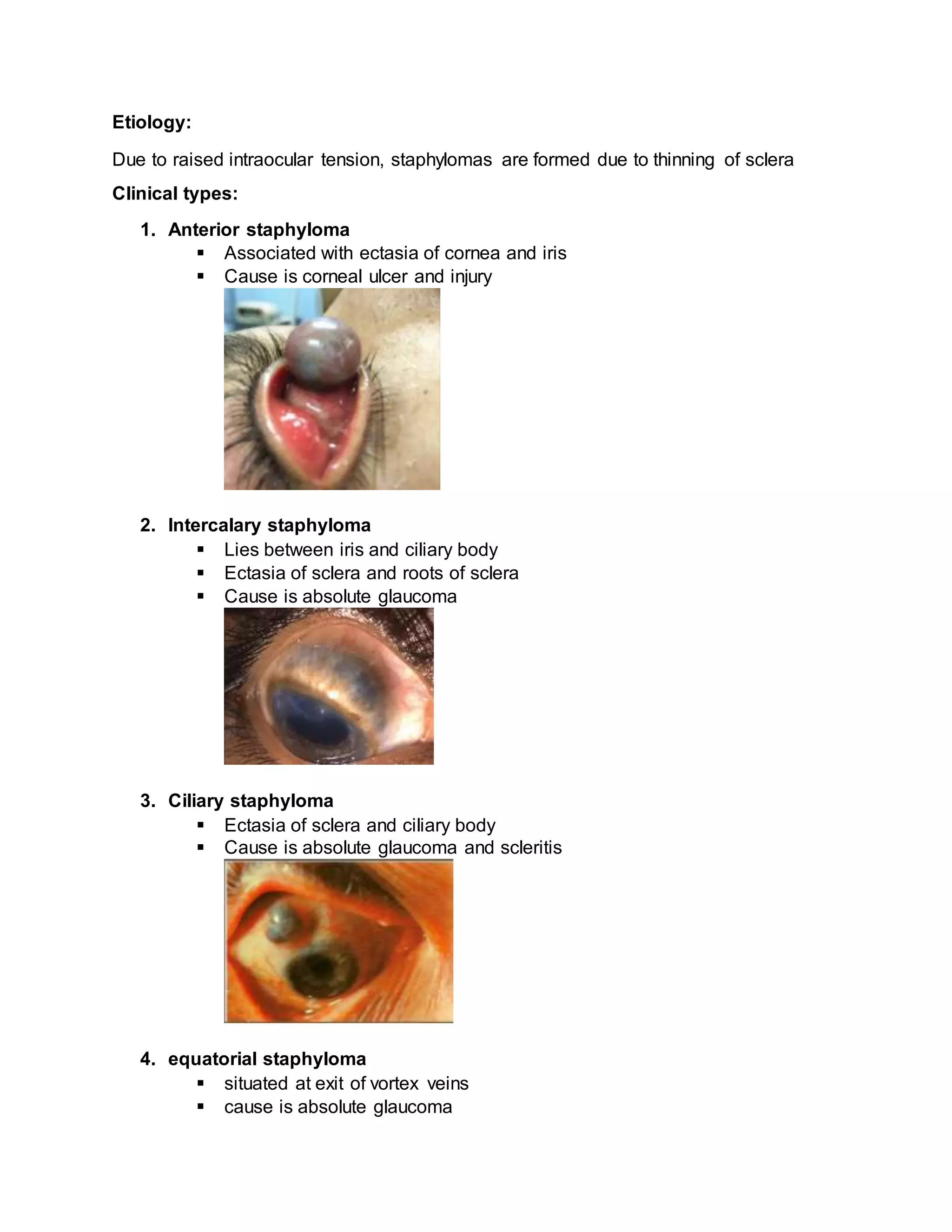 Sclera (scleritis and episcleritis, staphyloma) | DOCX