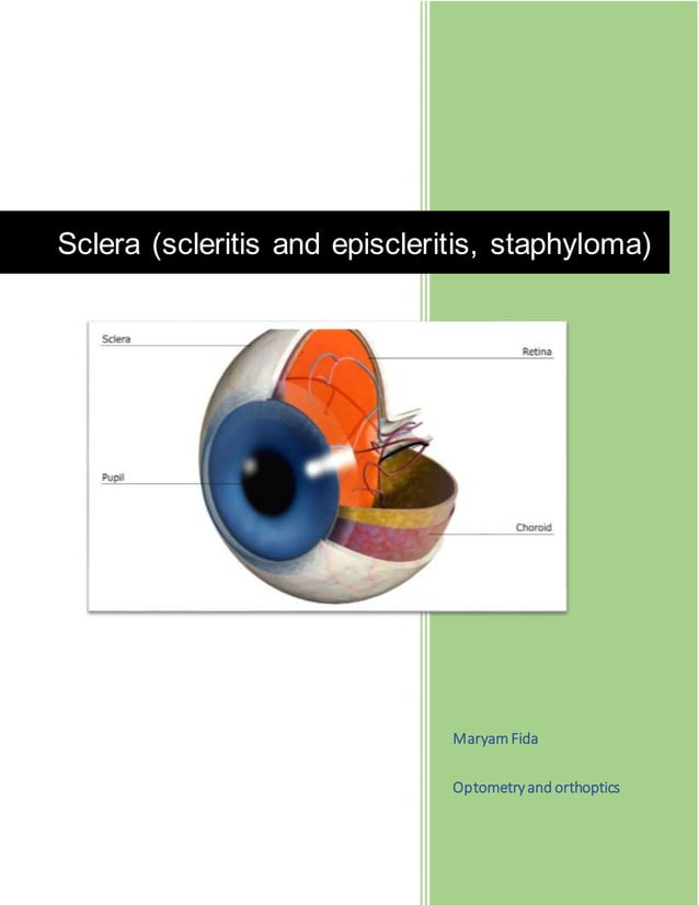 Sclera (scleritis and episcleritis, staphyloma) | DOCX | Eye and Vision ...