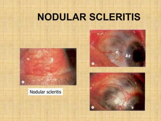 SCLERA.ppt | Eye and Vision Conditions | Diseases and Conditions