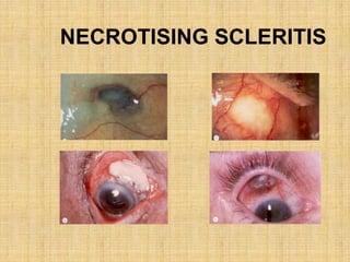 SCLERA.ppt | Eye and Vision Conditions | Diseases and Conditions