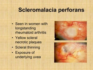 SCLERA.ppt | Eye and Vision Conditions | Diseases and Conditions