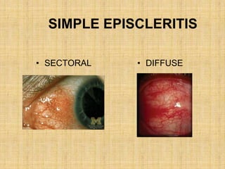 SCLERA.ppt | Eye and Vision Conditions | Diseases and Conditions