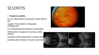 SCLERA.pptx