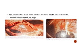 Anatomy & inflammatory disease of sclera | PPTX