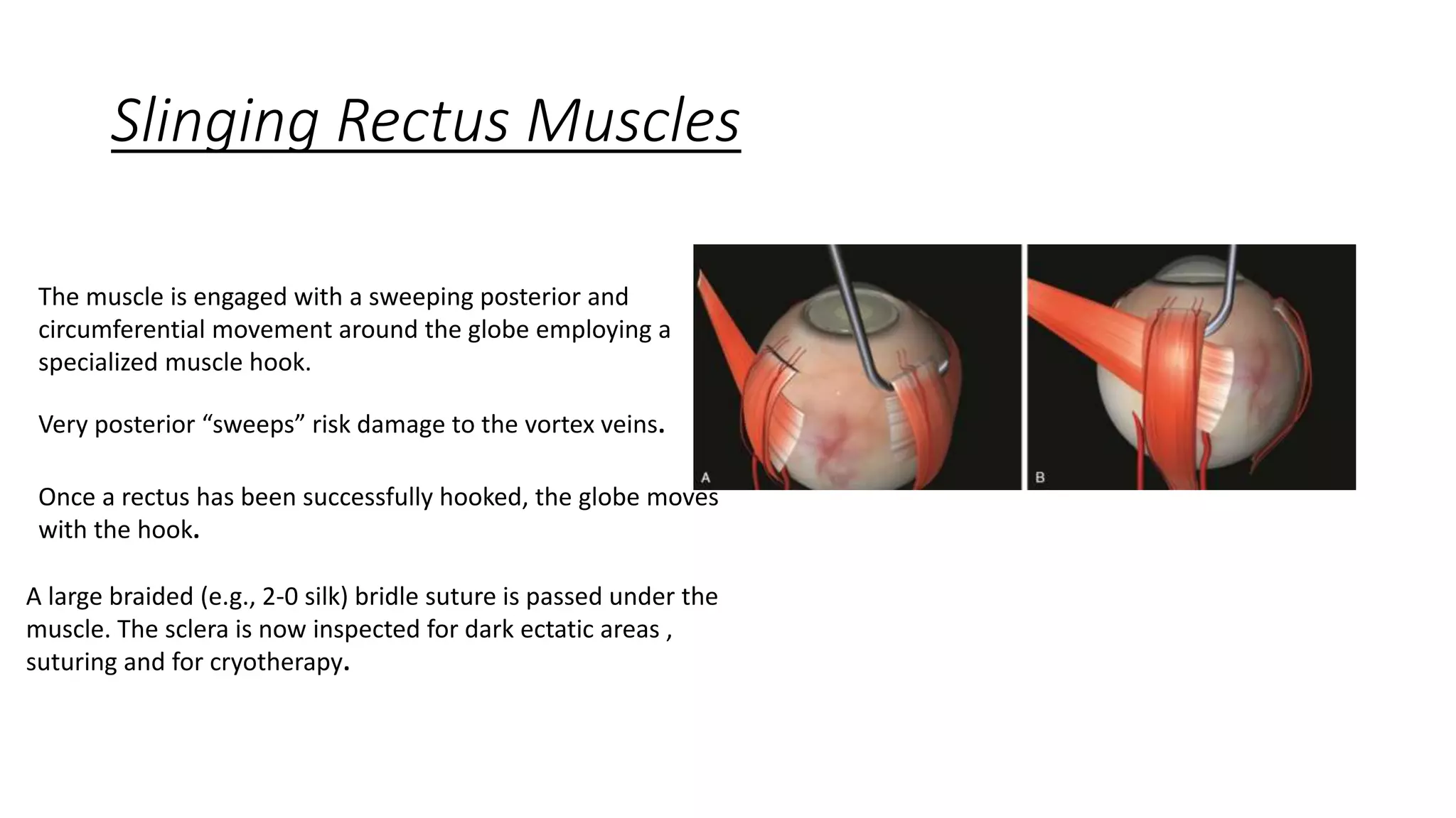 Scleral buckling for rhegmatogenous retinal detachment | PPTX
