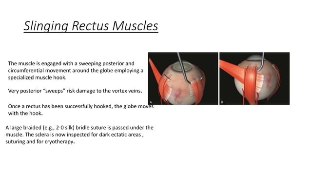 Scleral buckling for rhegmatogenous retinal detachment | PPTX | Eye and ...