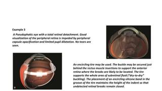 Scleral buckling for rhegmatogenous retinal detachment | PPTX