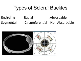 Scleral Buckling Materials and methods.pptx