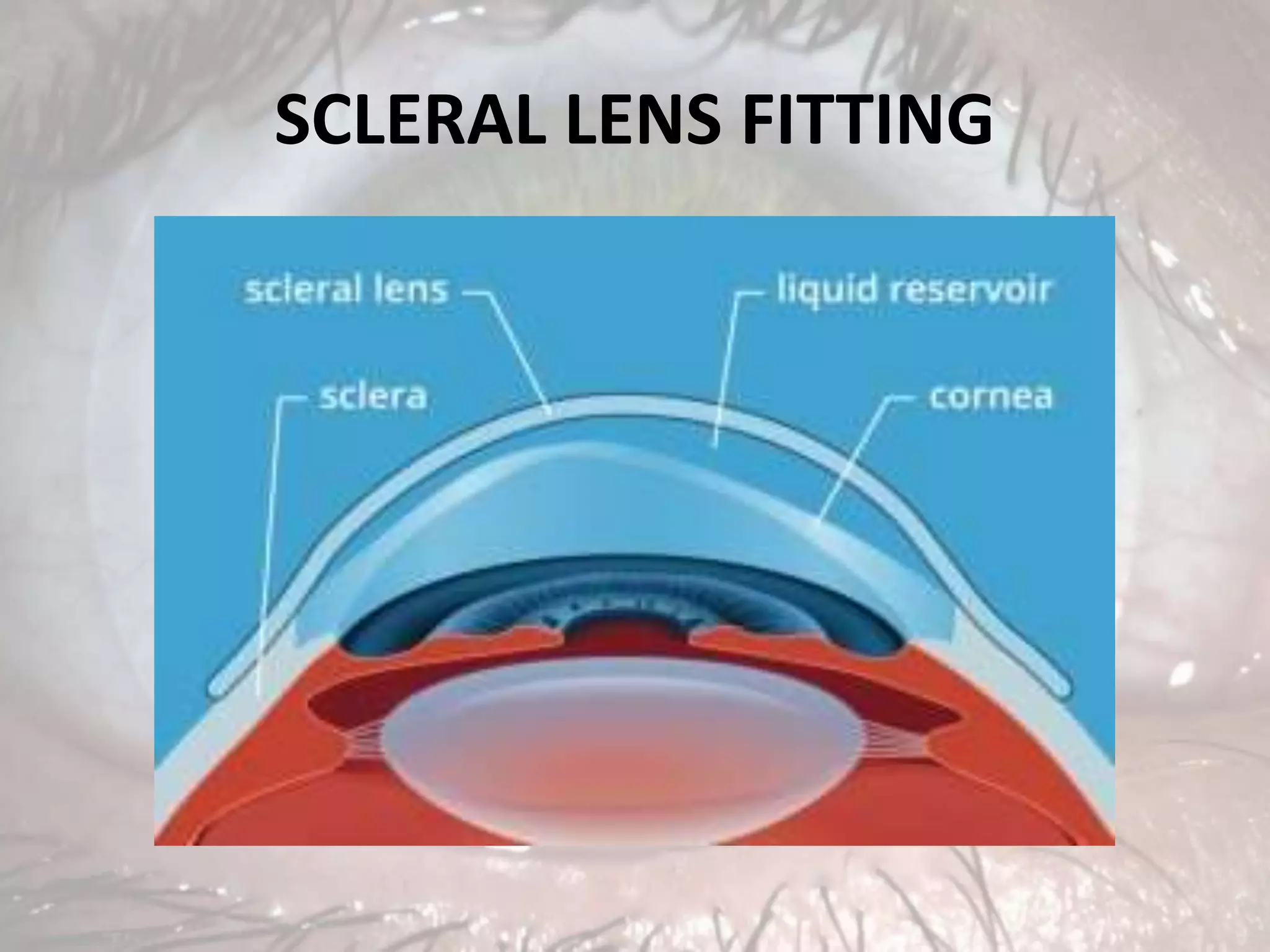 Scleral contact lens in Ophthalmology | PPTX