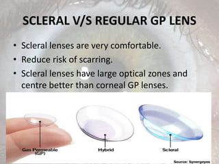 Scleral contact lens in Ophthalmology | PPT